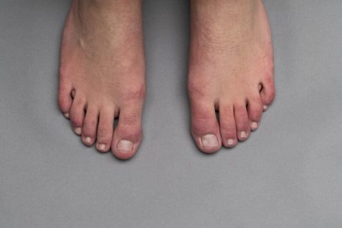 Covid Toe - How Coronavirus Can Affect Your Feet